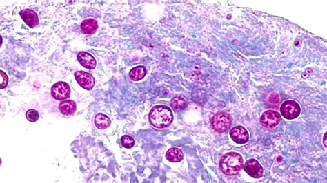 Cyclosporiasis Cases In Florida Us Could Be Undercounted Experts