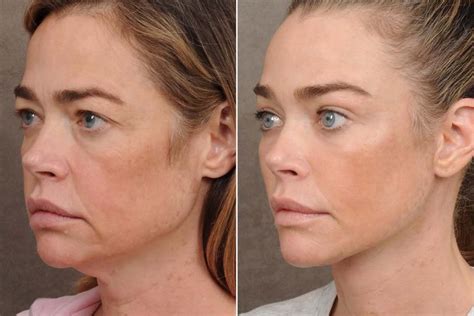 Denise Richards Breaks Down The Facial Plastic Surgery Shes Had Done