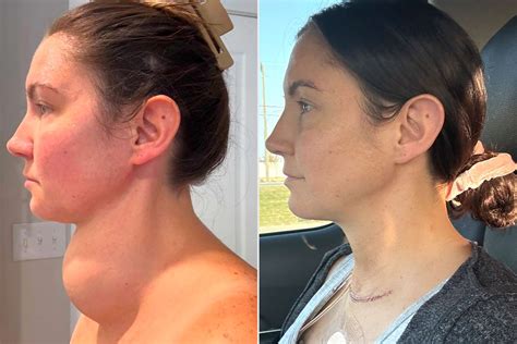 Doctor Dismissed Womans ‘frog Throat Then She Had Thyroid Removed