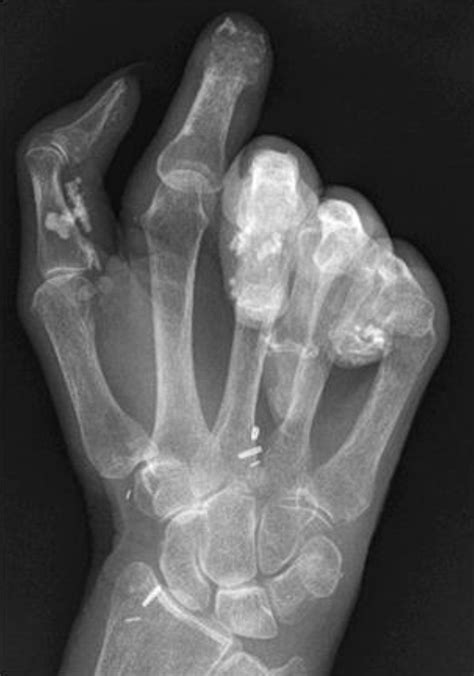 Musculoskeletal Manifestations Of Systemic Sclerosis Rheumatic