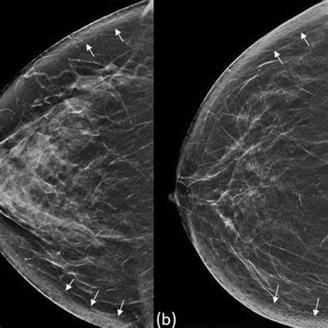 False Positive Calcifications S2d Image Shows High Density Linear