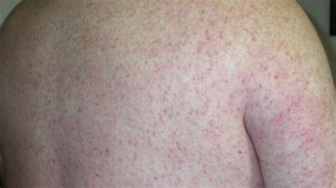 Viral Pharyngitis Rash