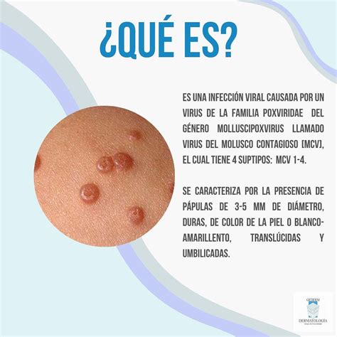 Molusco Contagioso En Las Manos