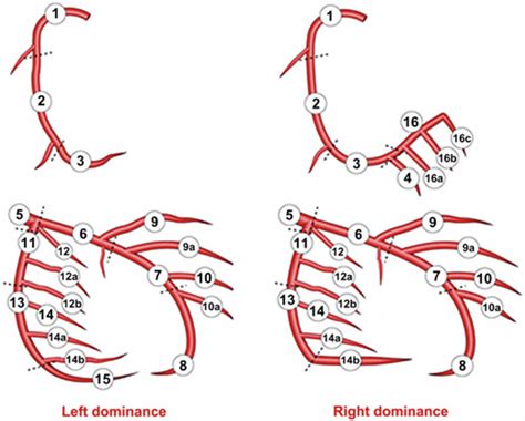 X Ray Coronary Angiogram Images And Syntax Score To Develop Machine