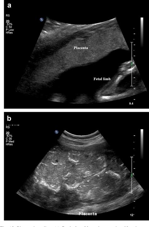 Figure 12 From Ultrasound Of The Placenta A Systematic Approach Part