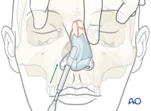 Nose Nasal Bone Fractures Rancho Santa Margarita Ca Orange County