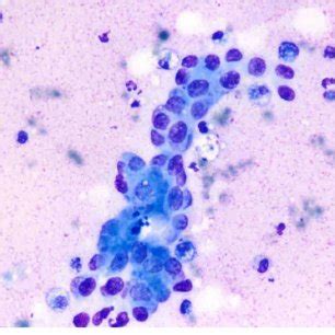 Lipoma Poorly Cellular Fine Needle Aspirate Smear With Abundant Free