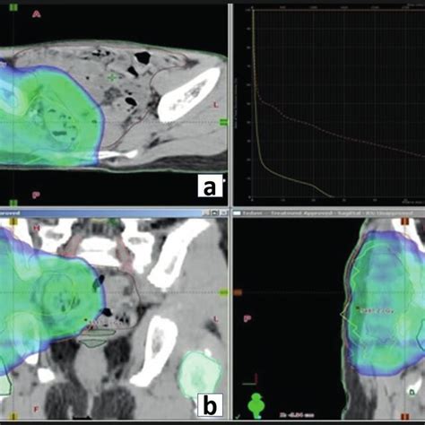 Radiotherapy Plan Of A Patient With Synovial Sarcoma Axial A