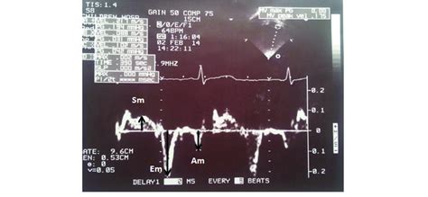 Example Of Calculations Of Mitral Annular Tissue Doppler Imaging Download Scientific Diagram