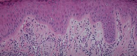 Dermatopathology Lesson 1 — Pathelective