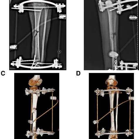 Preoperative X Ray And Three Dimensional Reconstruction Of Computed Download Scientific Diagram