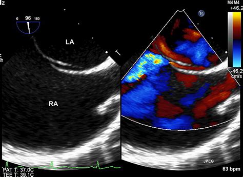 Patent Foramen Ovale Echocardiographic Detection And Clinical