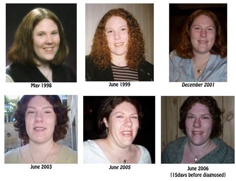Living With Acromegaly And Symptom Free How Did She Do It Patient