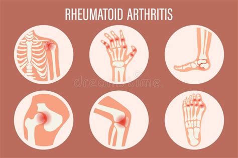 类风湿关节炎图标。膝关节、肩关节、腕关节、髋关节、足关节。关节炎类型。医学概念 向量例证 插画 包括有 臀部 爱好健美者 284229583