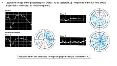Electroretinogram And Clinical Applications Pptx Eye And Vision