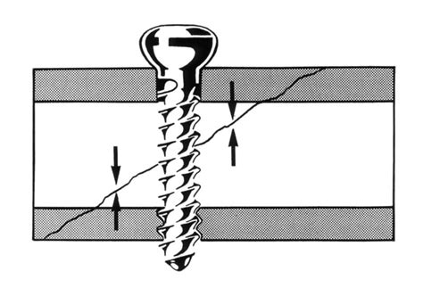 Should Plates And Screws Be Removed At Lola Goll Blog