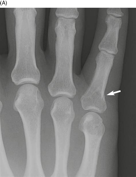 Broken Finger X Ray