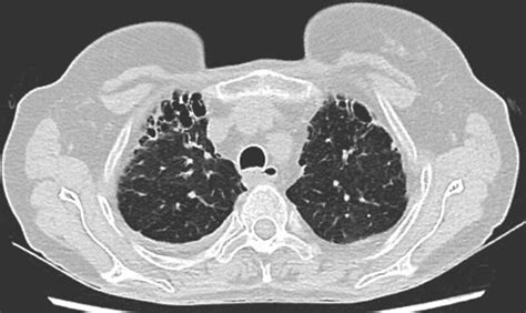 A 58 Year Old Woman With Systemic Sclerosis Axial Chest Computed Download Scientific Diagram