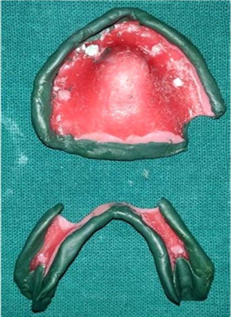 Cu Sil Denture A Novel Method To Preserve The Remaining Teeth And Bone