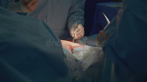 A Surgeon Carefully Stitches The Incision On A Woman S Belly During The