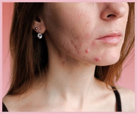 Congested And Acne Prone Skin Causes And Treatments — The Skin Manifesto