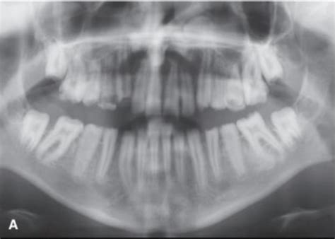 Developmental Anomalies Flashcards Quizlet
