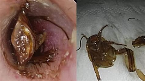 Cockroach Crawled Into Your Ear Heres What You Should Do According