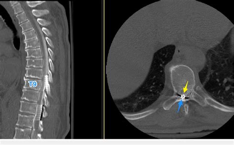 Ct Myelogram Showing The Catheter Yellow And The Stimulator Lead