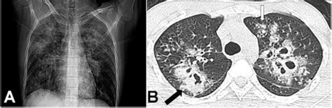A Chest X Ray Showing Bilateral Heterogeneous Opacities In The