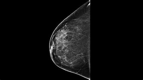 Digital Mammogram False Positive