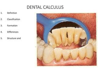 Lect 4 Dental Calculus Including Formation And Causespptx