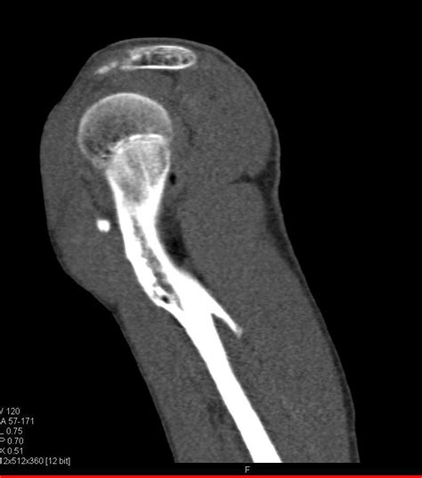 Multiple Exostosis Scapula And Humerus Musculoskeletal Radiology Case