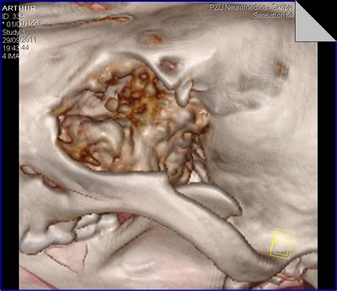 Retrobulbar Chondrosarcoma In A Dog Vets On The Balkans An Online