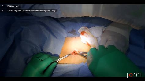 Pediatric Bilateral Indirect Inguinal Herniotomy Jomi