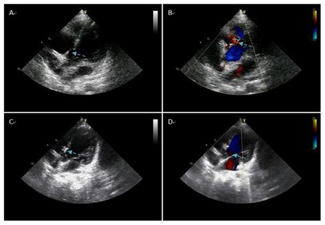 Comparison Of Tte Images At The Parasternal Five Chamber Section Before