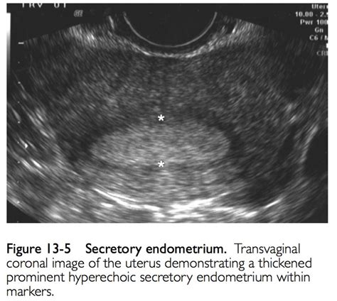 Uterine Ultrasound Imaging