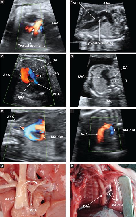 Truncus Arteriosus Echo