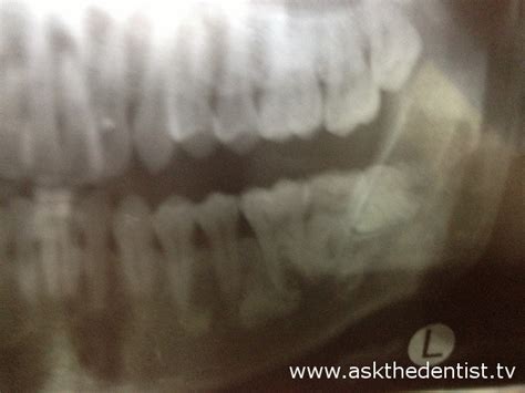 Odontectomy In Manila Ask The Dentist