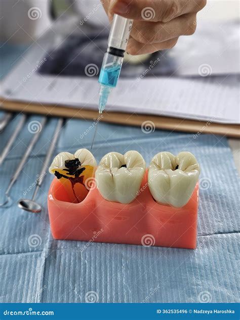 Pain Relieving Tooth Injections Injection Of Anesthetic Into Gum And