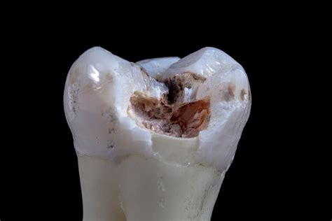 Pictures Of Granulation Tissue After Tooth Extraction Your Visual Guide To