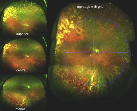 Retinal Thinning Icd 10 Retina Icd 10 Cm Quick Reference Guide Bykbry