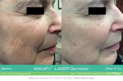 Cutera Laser Genesis Inland Cosmetic Surgery Ahava Medspa And Made