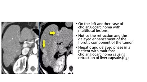 Triphasic Ct Scan Pptx