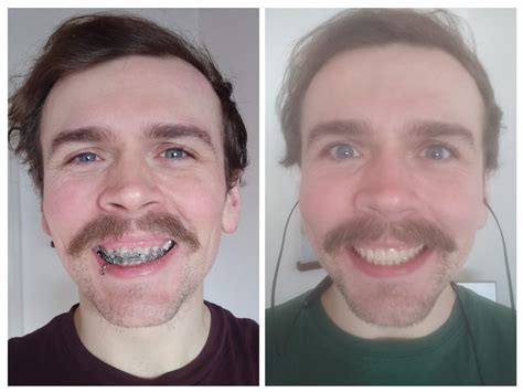 Braces Finally Came Off After More Than Two Years Rbraces