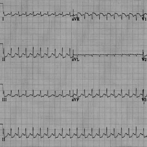 Adult Tachycardia Rcemlearning India