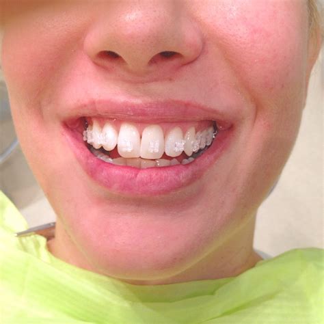 Ποια Ελληνίδα παρουσιάστρια φόρεσε σιδεράκια