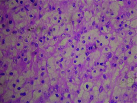 Photomicrograph Showing Clear Cells With Vesicular Nuclei H And E