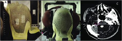 Immobilization Of The Patient Using The Stereotactic Thermoplastic Mask Download Scientific