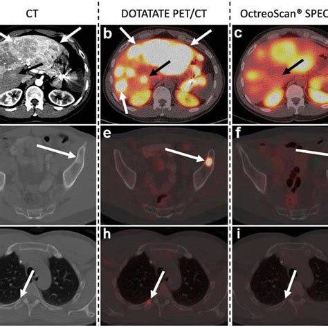 Favorable Imaging Of Net With Dotatate Pet Over Ct And Download