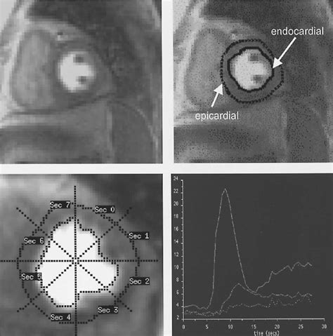 perfusion analysis with dedicated cardiac software top left the